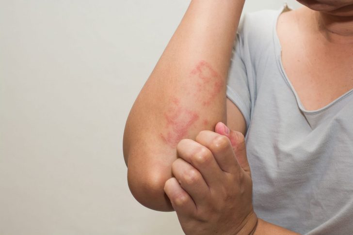 Effective Eczema Treatments at Universal Dermatology