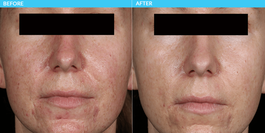 Explore Your Rosacea Treatment Options in Central Ohio